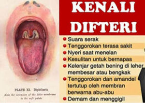 Gejala Dan Bahaya Difteri - AMC Balikpapan